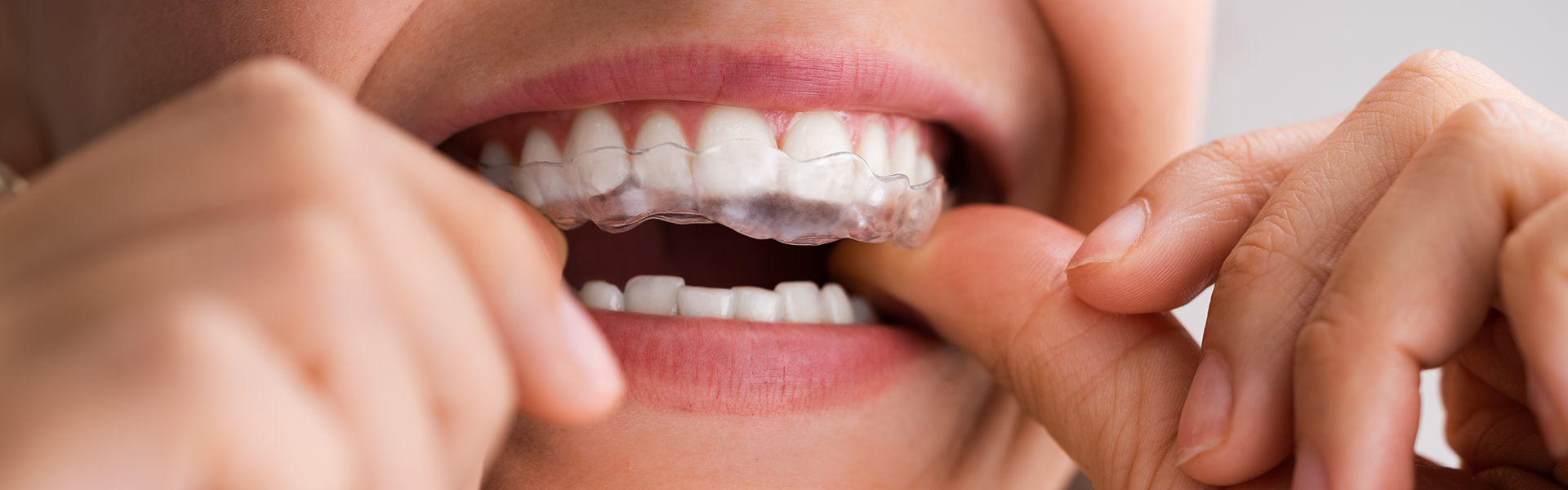 What to Know About Invisalign and Its Effectiveness