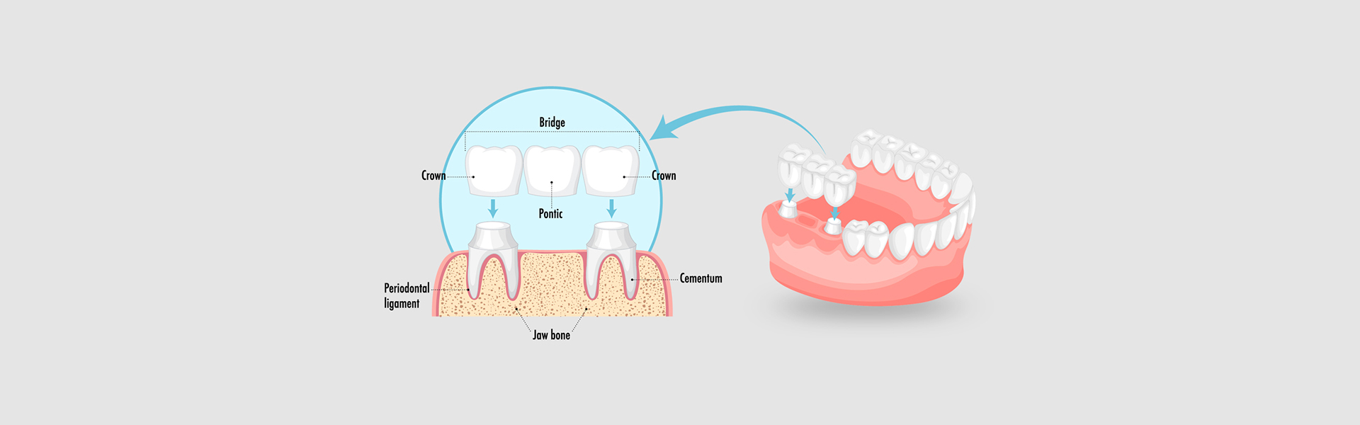 All You Need To Know About Dental Bridges: Key Facts